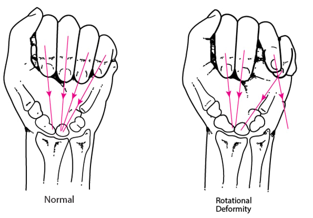 Image:Rotational deformity due to a fracture in the hand-MSD Manual ...
