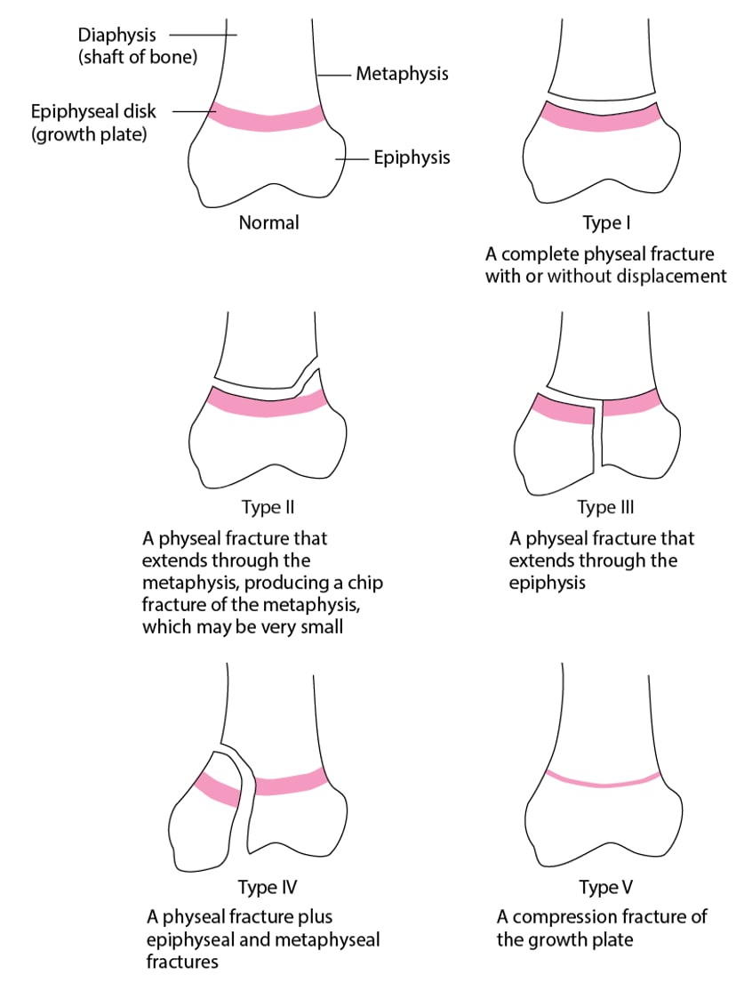 Image:Salter-Harris Classification of Physeal Disk (Growth Plate ...