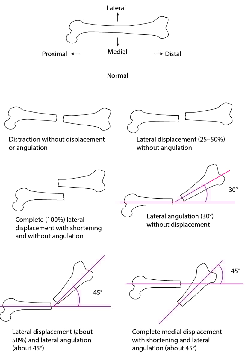 Overview of Fractures - Injuries; Poisoning - Merck Manual Professional ...