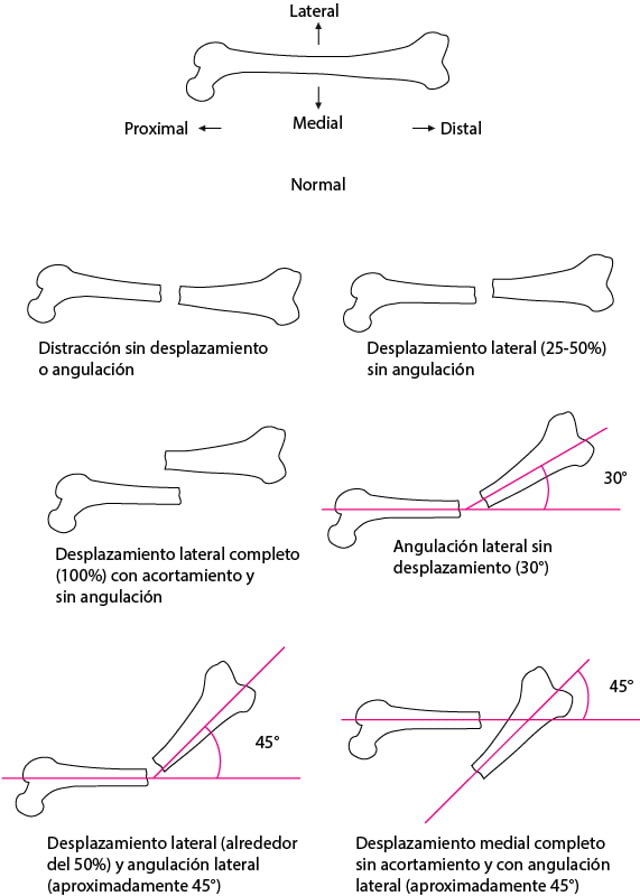 Generalidades sobre las fracturas - Lesiones y envenenamientos - Manual ...