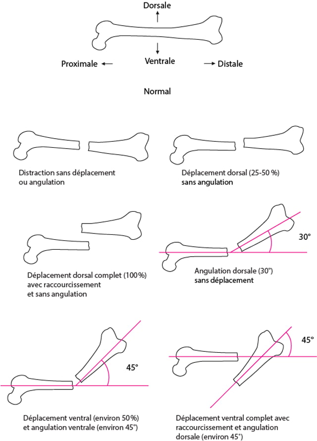 Revue générale des fractures - Blessures; empoisonnement - Édition ...