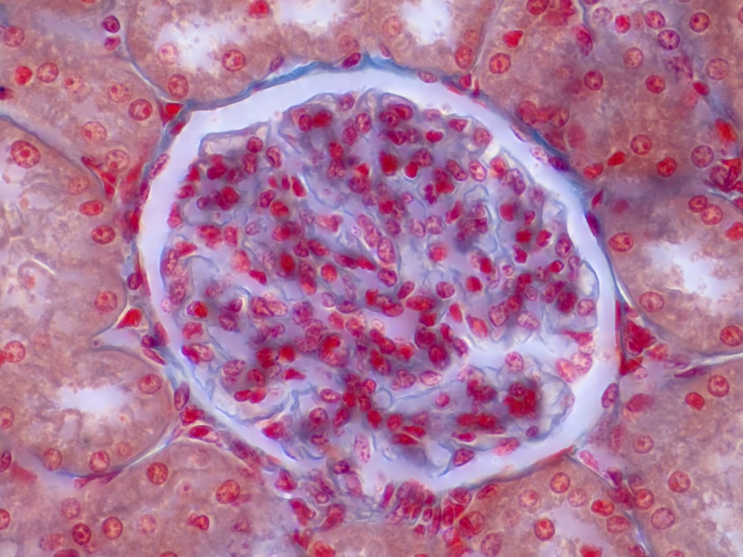 Overview of Glomerular Disorders - Genitourinary Disorders - MSD Manual ...