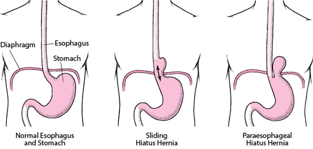 Hiatus Hernia - Gastrointestinal Disorders - MSD Manual Professional ...