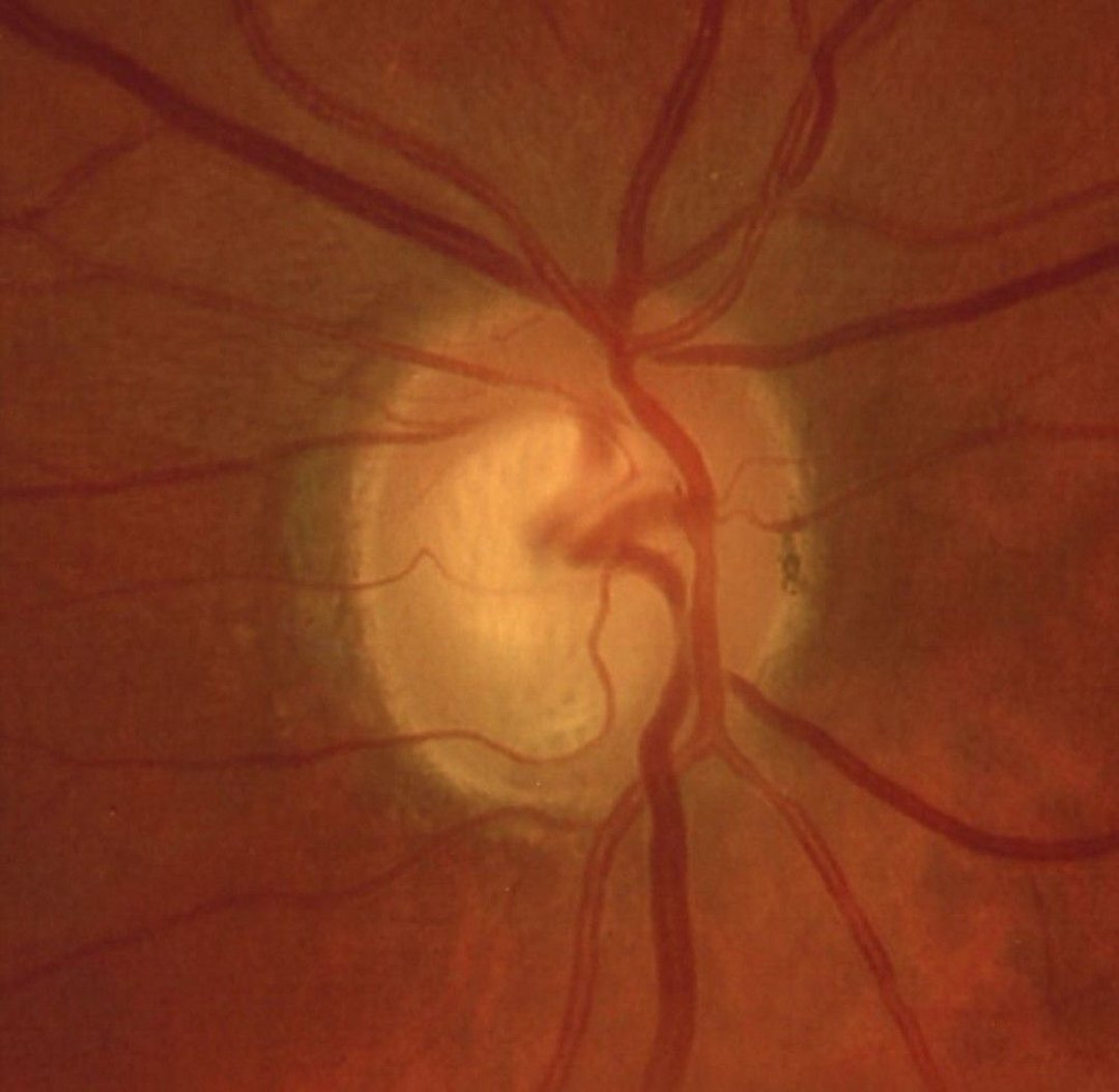 Primary Open-Angle Glaucoma - Eye Disorders - Merck Manual Professional ...