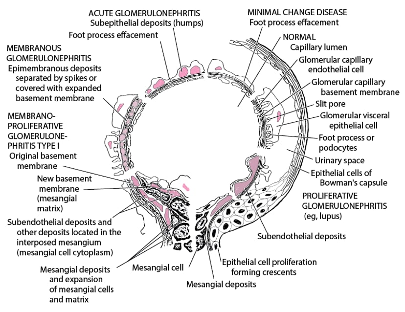 Overview of Glomerular Disorders - Genitourinary Disorders - MSD Manual ...