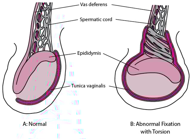 Imageabnormal Testicular Fixation Leading To Torsion Merck Manual Professional Edition