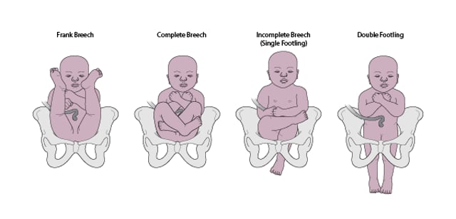 Fetal Presentation, Position, and Lie (Including Breech Presentation ...
