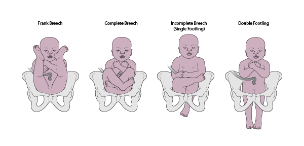 Fetal Presentation, Position, and Lie (Including Breech Presentation ...