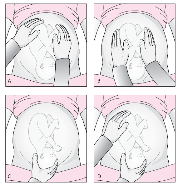 Management of Normal Labor - Gynecology and Obstetrics - Merck Manual ...