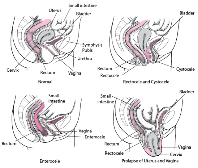 Image Pelvic Organ Prolapse Merck Manual Professional Edition
