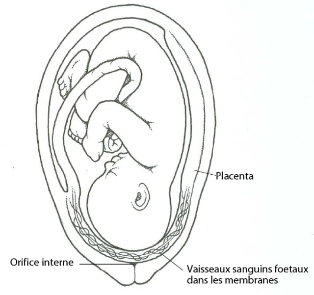 Vasa praevia - Gynécologie et obstétrique - Édition professionnelle du ...