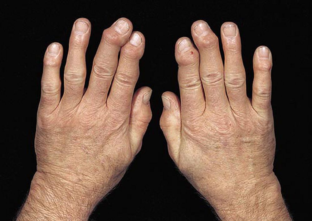 Arthrose - Erkrankungen des rheumatischen Formenkreises und des ...