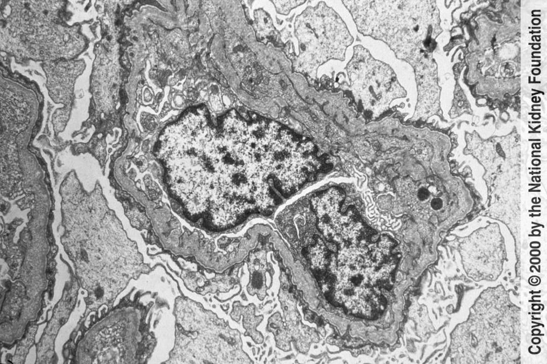 Alport Syndrome - Nephrology - MSD Manual Professional Edition