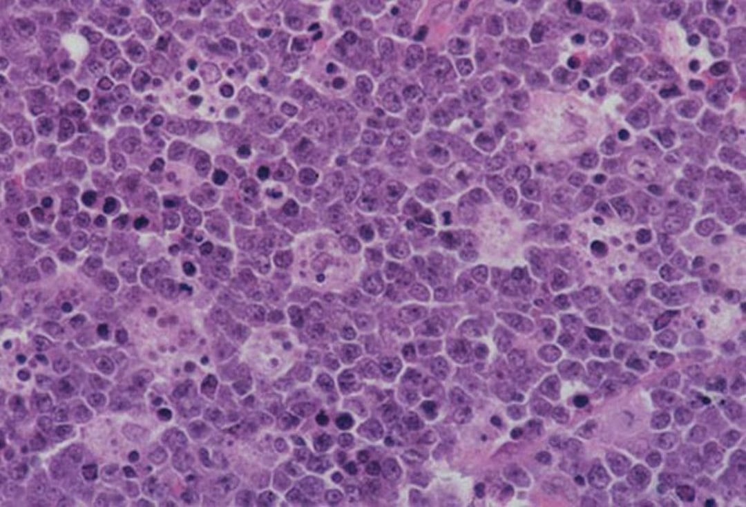 Burkitt Lymphoma - Hematology and Oncology - MSD Manual Professional ...