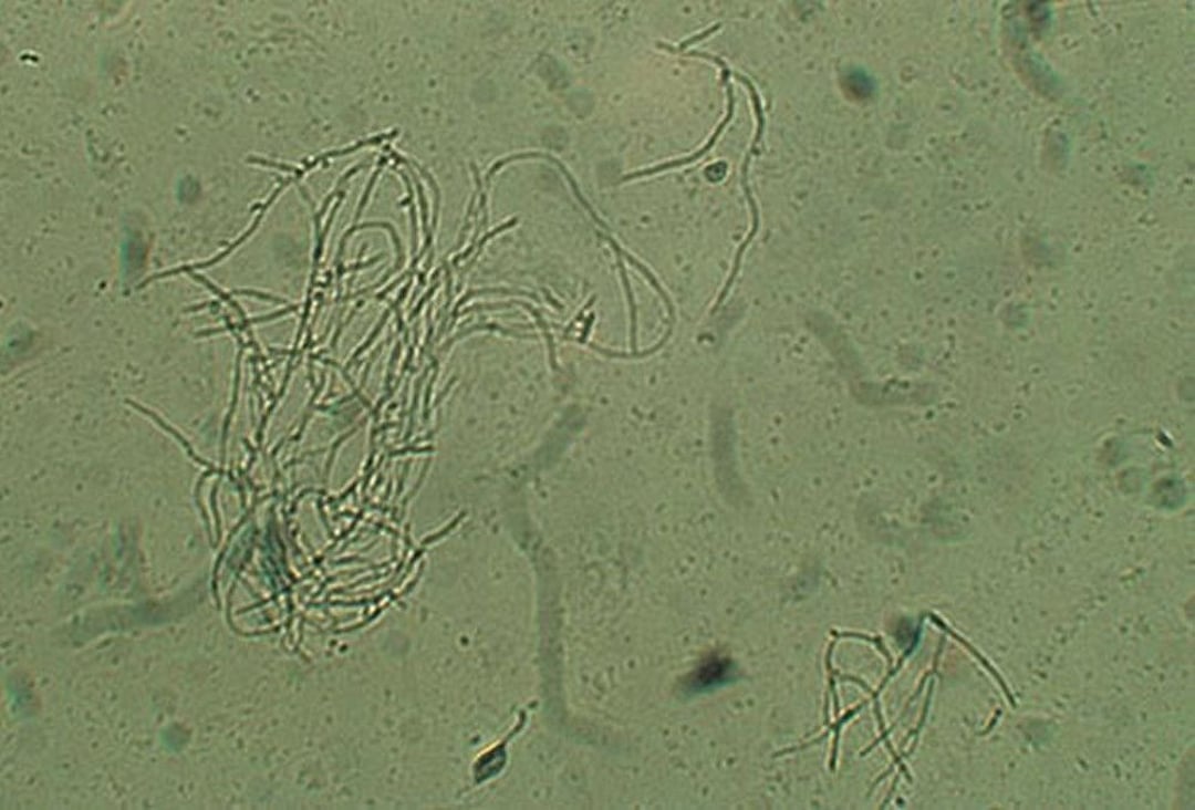 Candidal Vaginitis - Gynecology and Obstetrics - MSD Manual ...