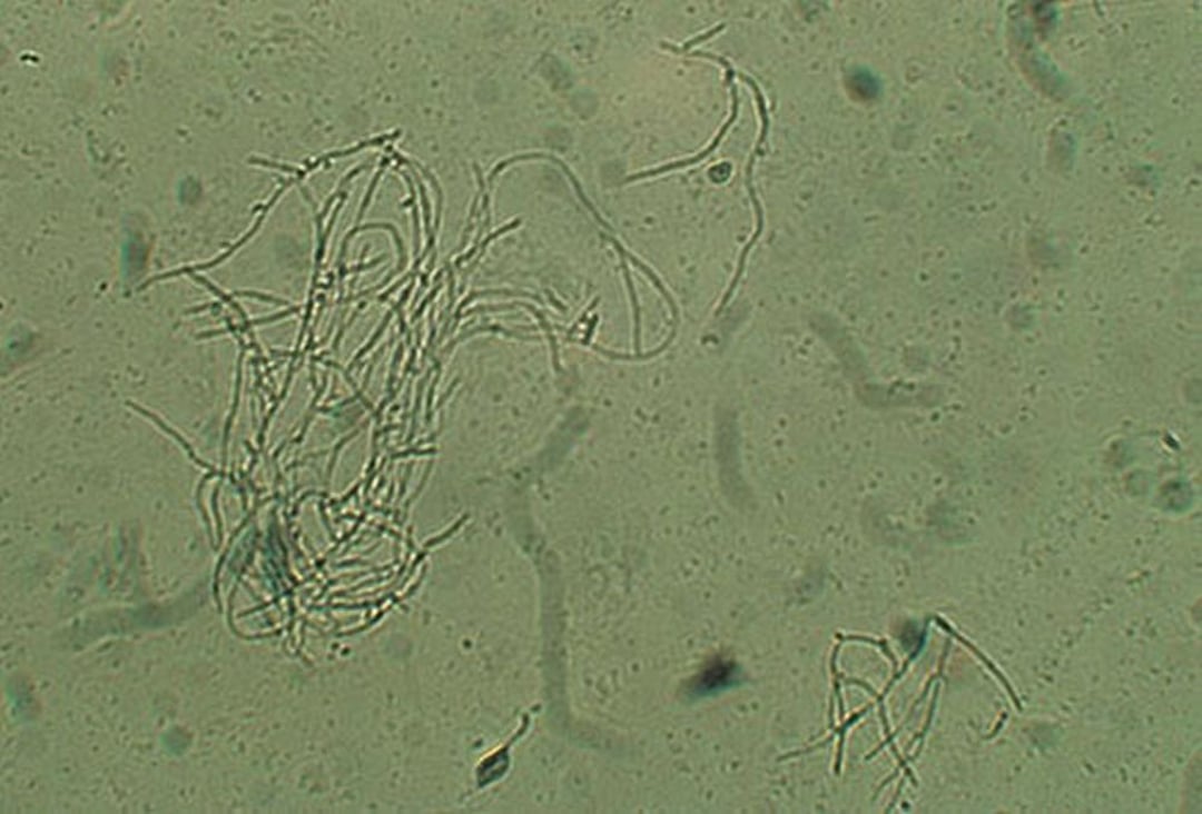 Candida-Vaginitis - Candida-Vaginitis - MSD Manual Profi-Ausgabe