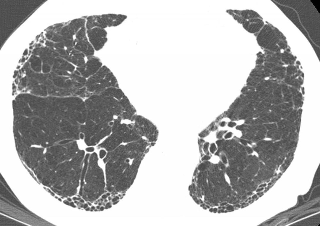 Idiopathic Pulmonary Fibrosis (IPF) - Pulmonology - MSD Manual ...