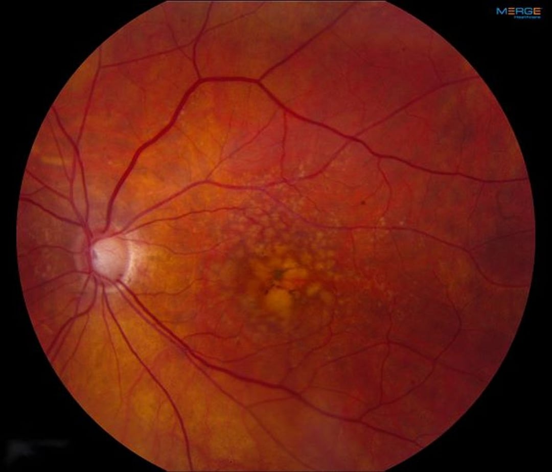 Degeneração macular relacionada à idade (DMRI) - Degeneração macular ...