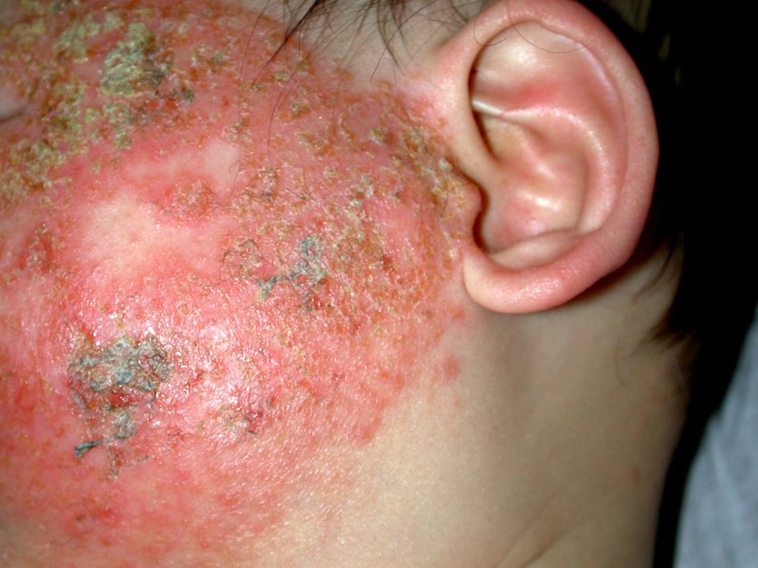 Atopic Dermatitis (Eczema) - Dermatologic Disorders - Merck Manual ...