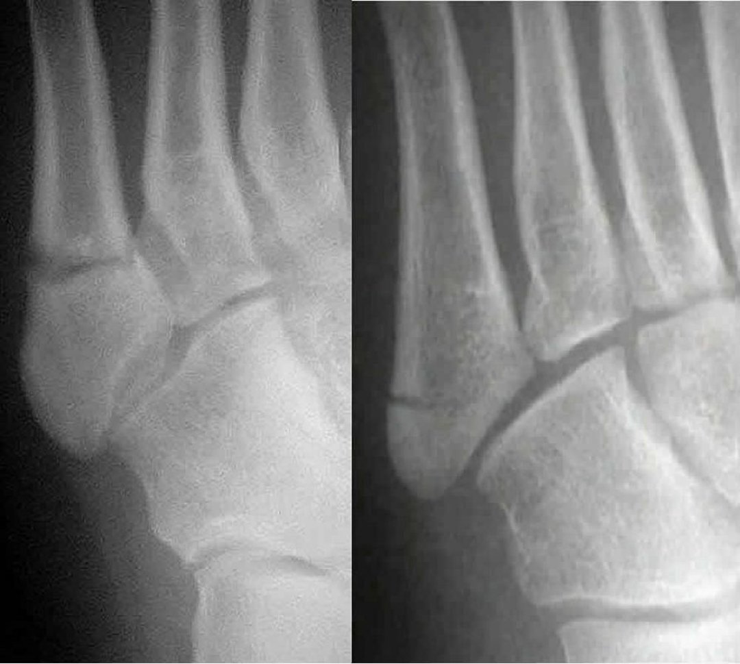 Fractures de la base du 5e métatarsien - Blessures; empoisonnement ...