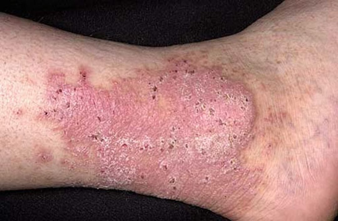 Image:Lichen Simplex Chronicus (Ankle)-Merck Manual Professional Edition
