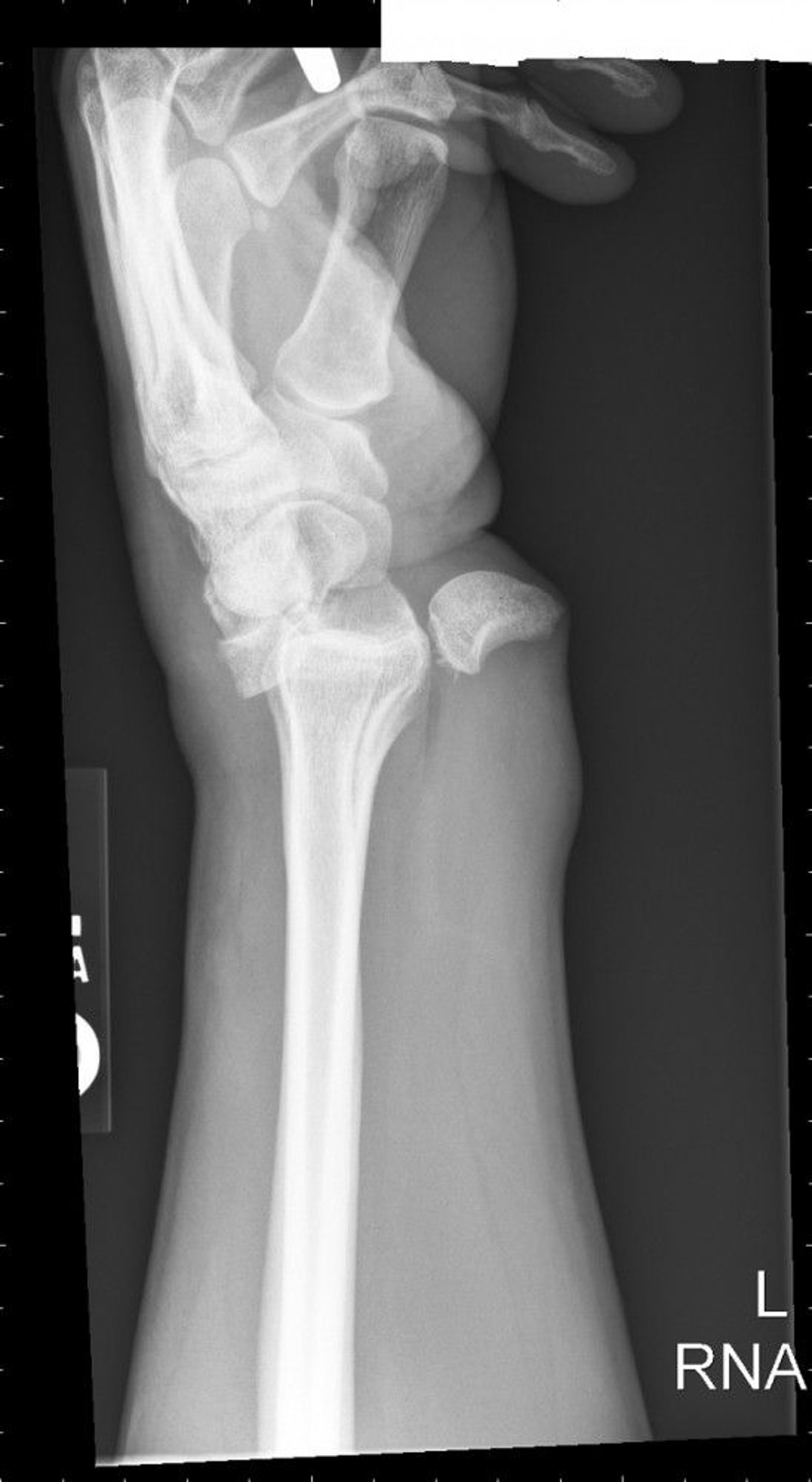 Image:Lunate Dislocation-MSD Manual Professional Edition