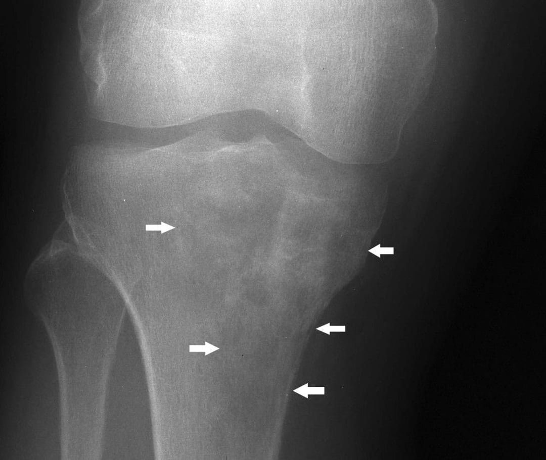 Image:Lymphoma of Bone-Merck Manual Professional Edition