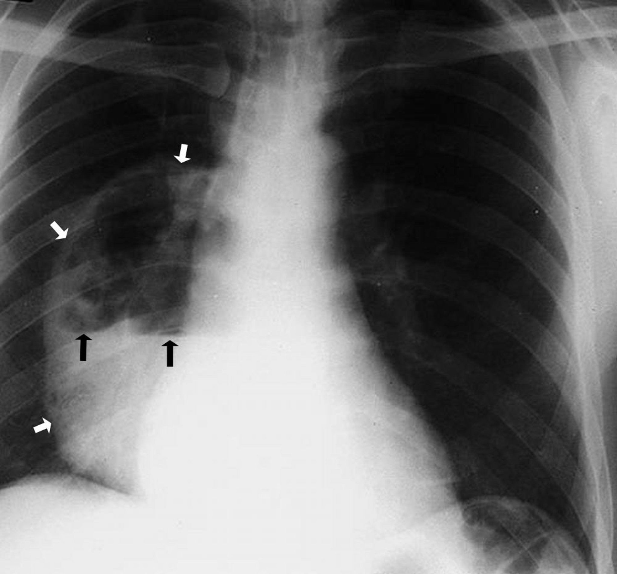 Image:Absceso pulmonar (radiografía)-Manual MSD versión para profesionales