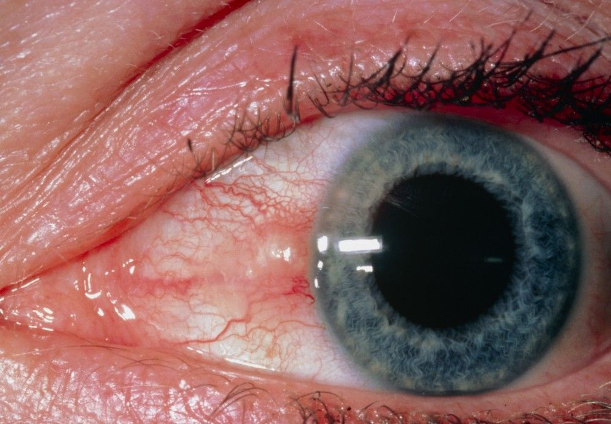 Pinguecula And Pterygium Eye Disorders Merck Manual Professional Pinguecula And Pterygium Eye Disorders Merck Manual Professional