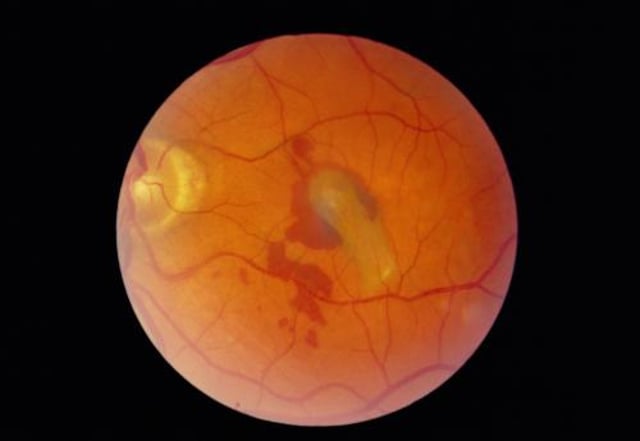 網膜剥離 - 網膜剥離 - MSDマニュアル プロフェッショナル版