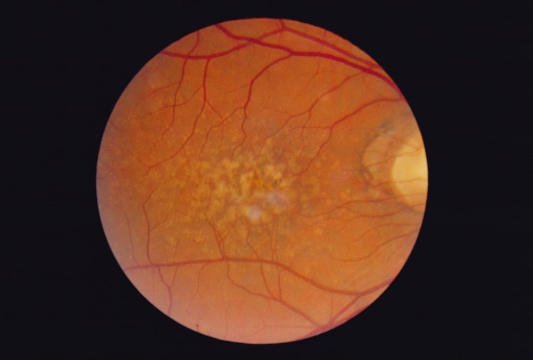 Age-Related Macular Degeneration (AMD or ARMD) - Eye Disorders - MSD ...