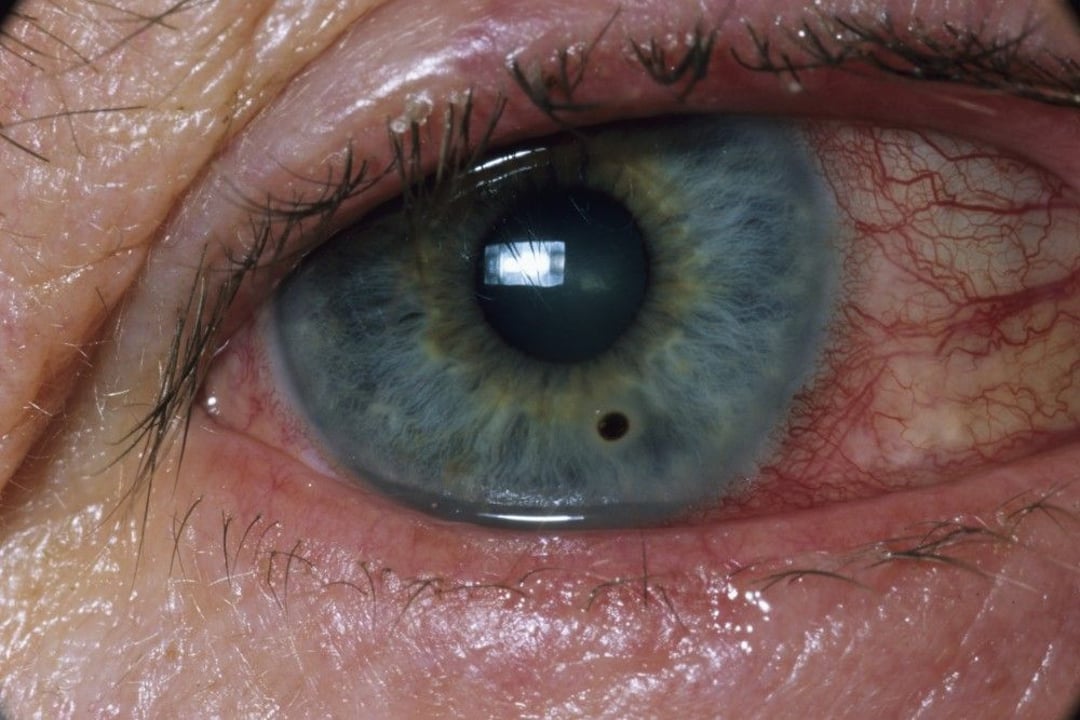 Corneal Abrasions and Corneal Foreign Bodies - Injuries; Poisoning ...