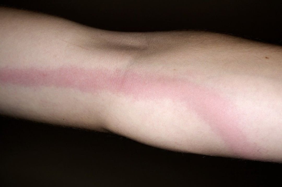 Lymphangitis - Dermatologic Disorders - Merck Manual Professional Edition