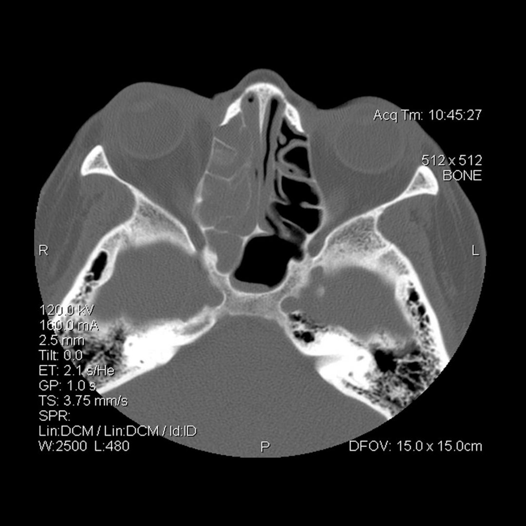 Sinusitis - Ear, Nose, and Throat Disorders - MSD Manual Professional ...
