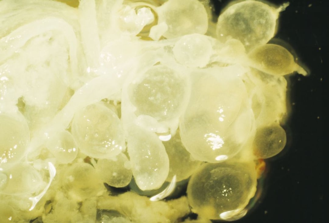 Enfermedad trofoblástica gestacional - Ginecología y obstetricia ...