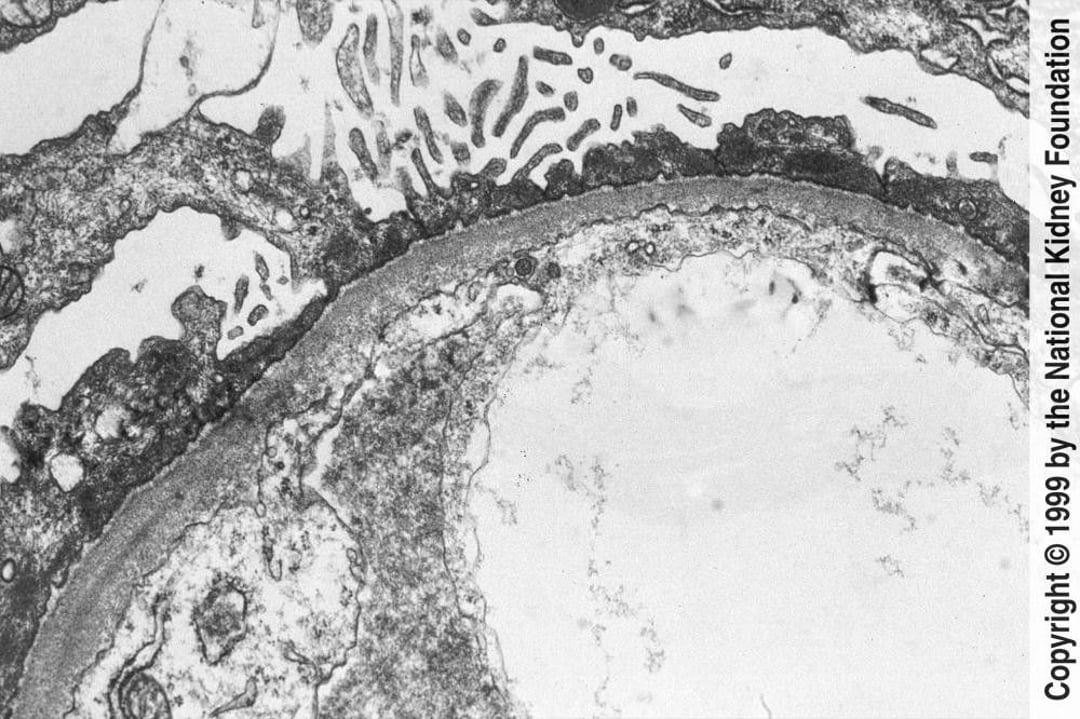 Minimal Change Disease - Nephrology - MSD Manual Professional Edition