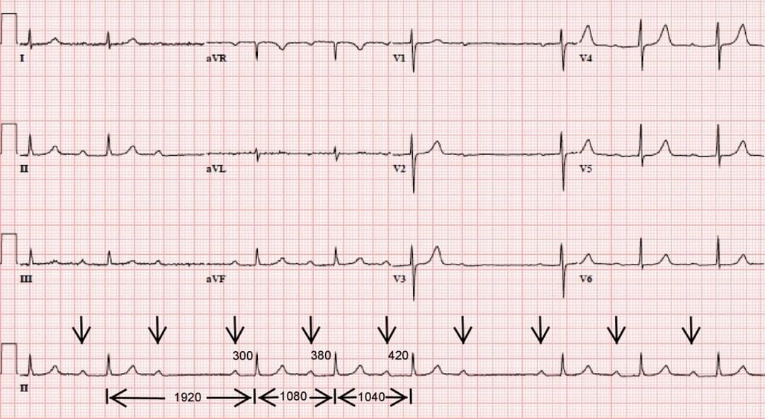 Atrioventricular Block - Cardiovascular Disorders - MSD Manual ...