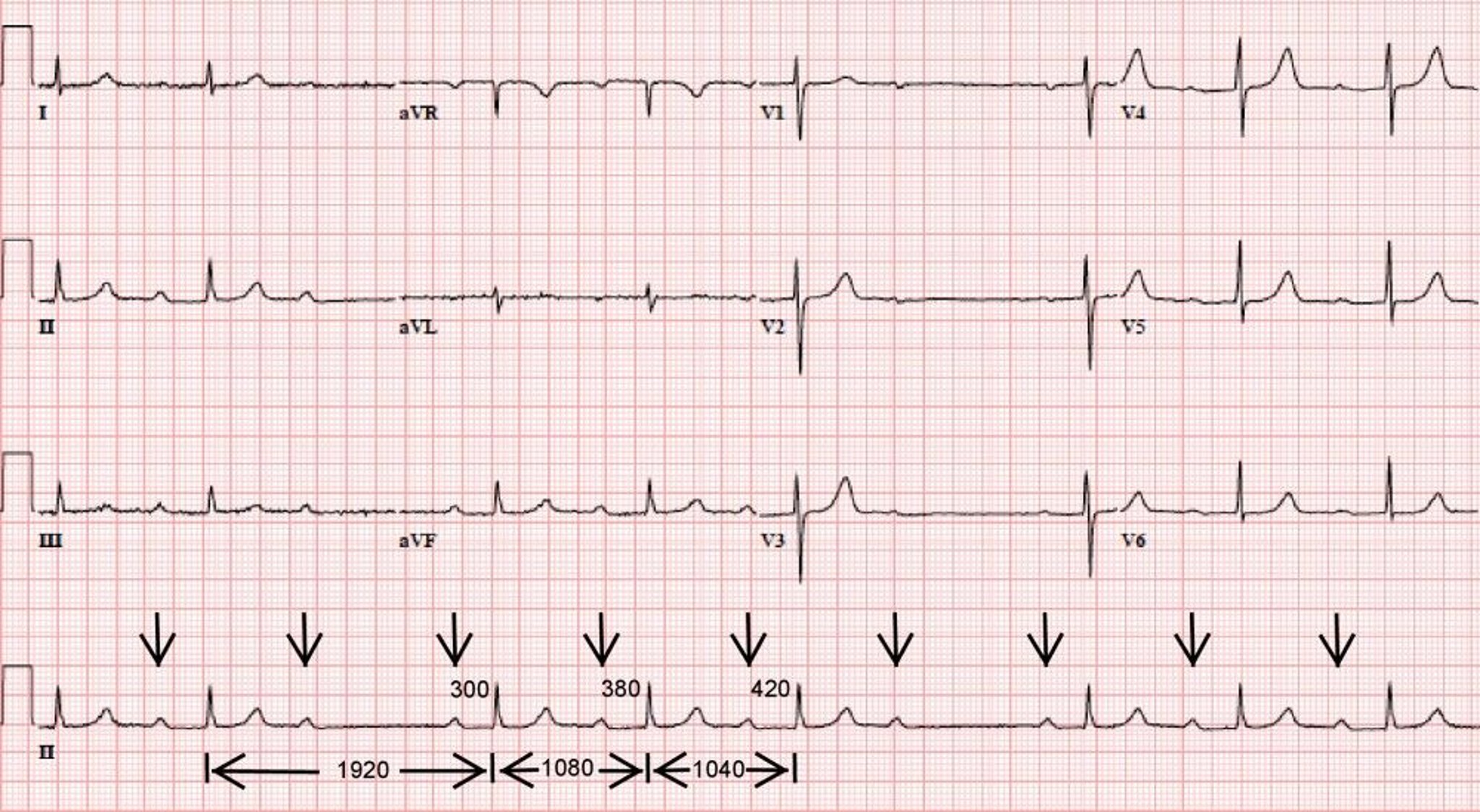 Image:4:3 Mobitz Type I Second-Degree Atrioventricular Block-Merck ... Image:4:3 Mobitz Type I Second-Degree Atrioventricular Block-Merck ...