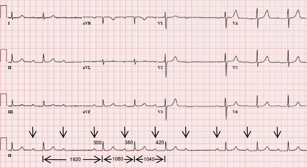 Image:Classic 4:3 Mobitz Type I Second-Degree Atrioventricular Block ...