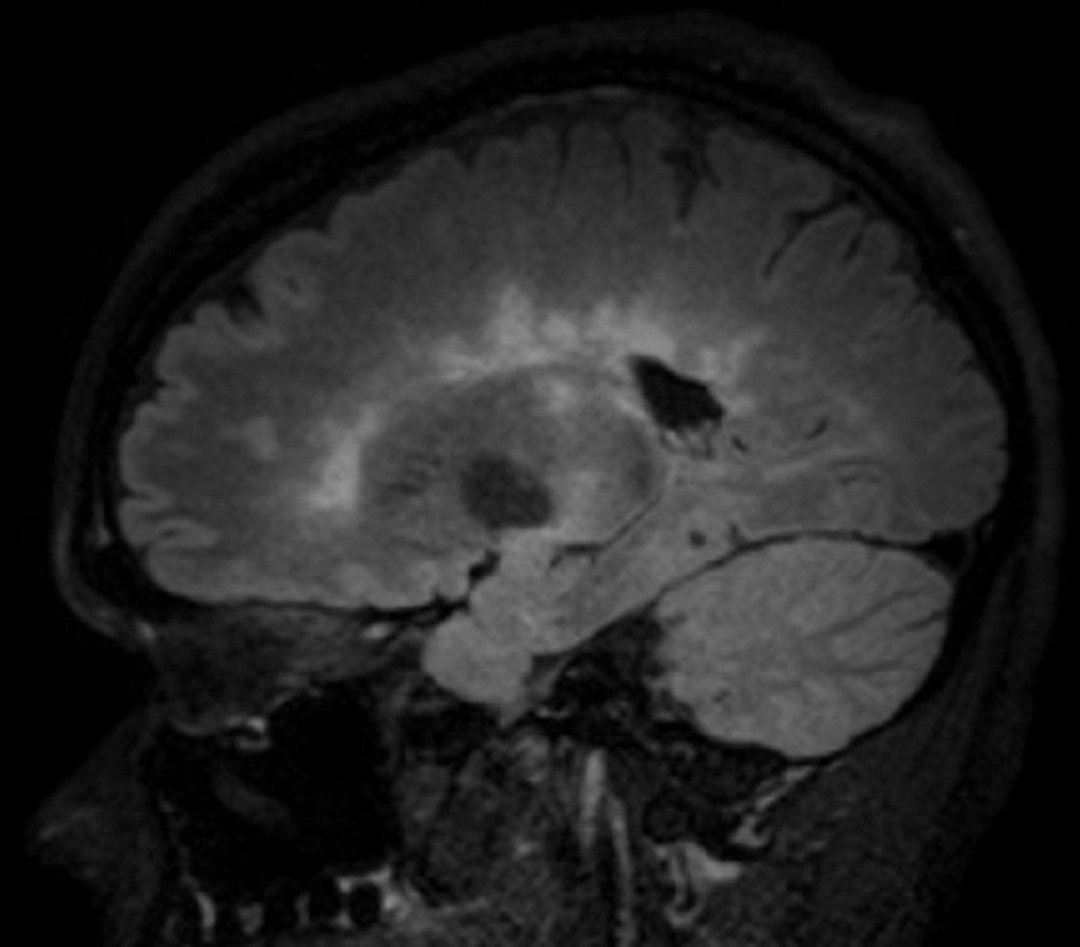 Image:MRI (FLAIR) Multiple Sclerosis-MSD Manual Professional Edition