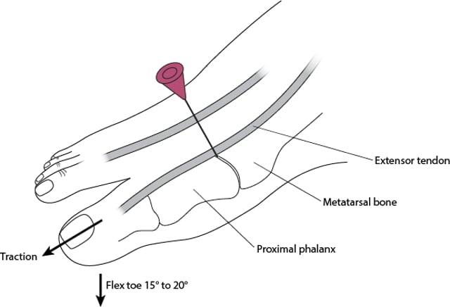 How To Do Metatarsophalangeal Joint Arthrocentesis - Musculoskeletal ...