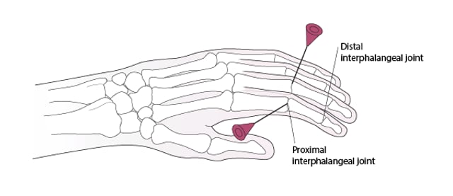 How To Do Metacarpophalangeal and Interphalangeal Joint Arthrocentesis ...