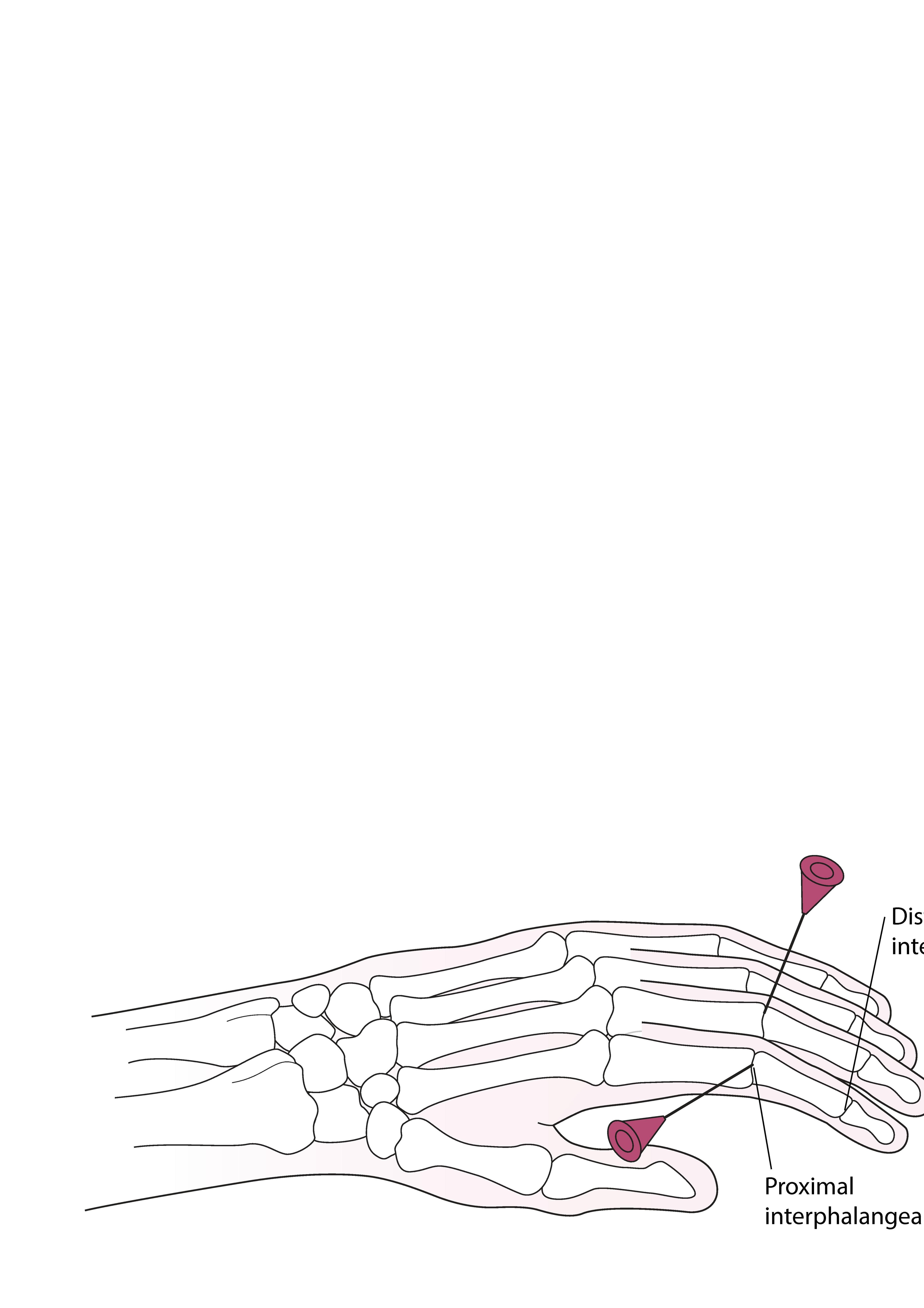 Image:Artrocentesis de la articulación interfalángica proximal-Manual ...