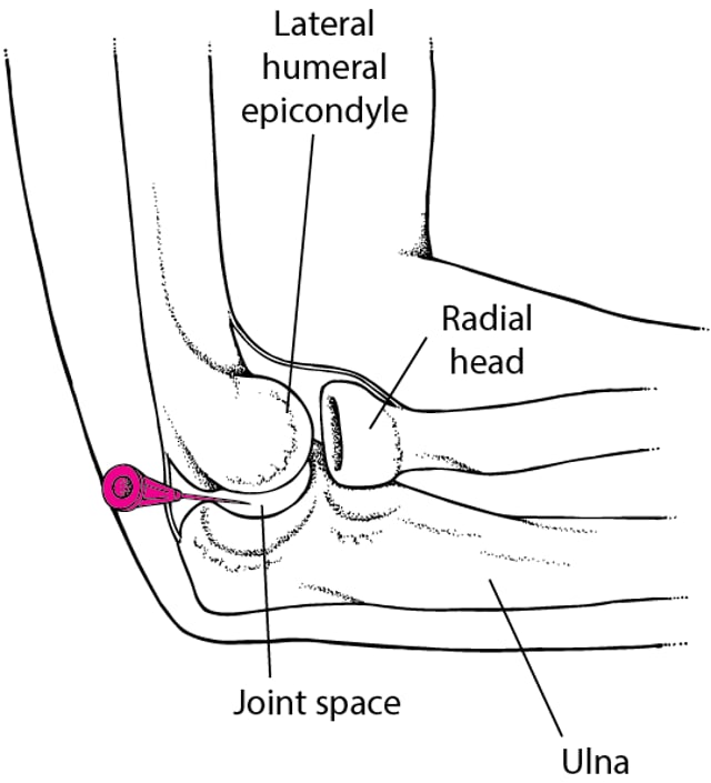 How To Do Elbow Arthrocentesis - Musculoskeletal and Connective Tissue ...