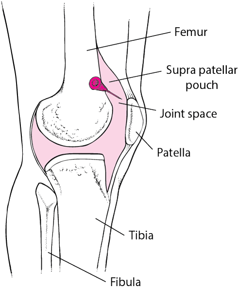 How To Do Knee Arthrocentesis - Musculoskeletal and Connective Tissue ...
