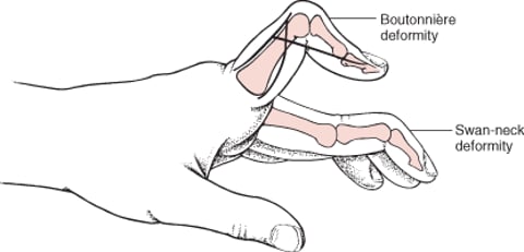Boutonnière Deformity - Musculoskeletal and Connective Tissue Disorders ...