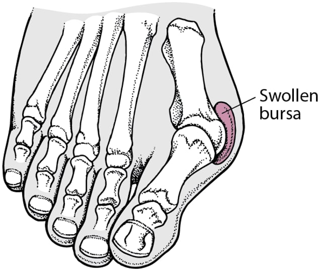 Bunion - Rheumatology and Orthopedics - Merck Manual Professional Edition