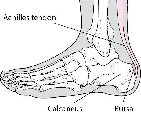 Anterior Achilles Tendon Bursitis - Rheumatology and Orthopedics ...