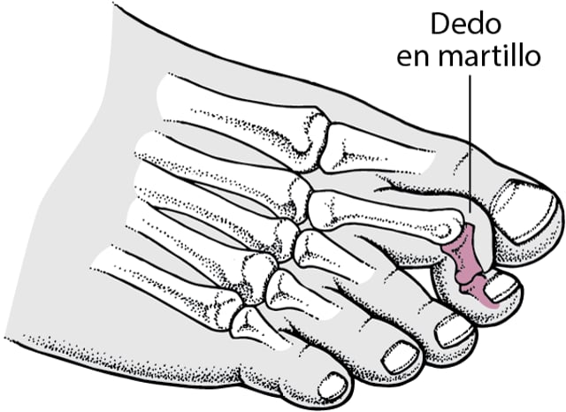 Deformidad del dedo en martillo - Trastornos de los tejidos ...