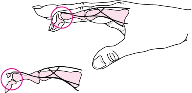 Mallet Finger - Injuries; Poisoning - MSD Manual Professional Edition